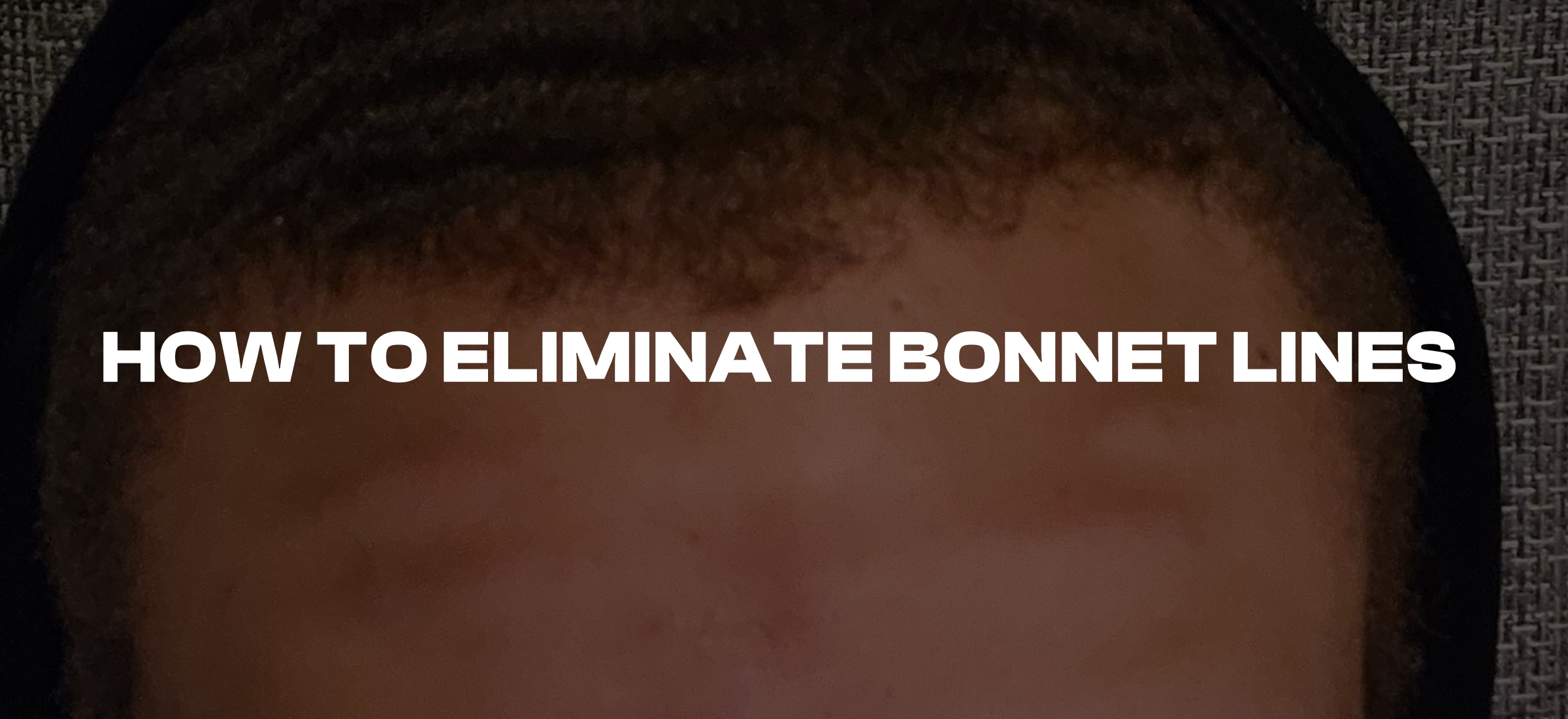 How to Eliminate Bonnet Lines on Your Forehead: Expert Tips and Tricks ...